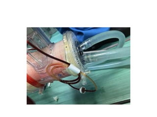 Cpb oxygenators DR NIKUNJ R SHEKHADA (MBBS,MS GEN SURG ,DNB CTS SR) | PPTX