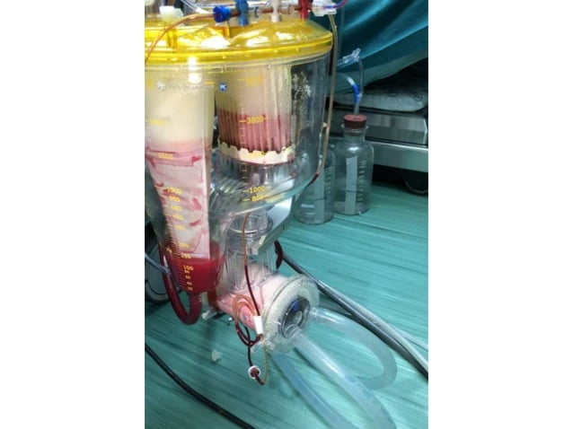 Cpb oxygenators DR NIKUNJ R SHEKHADA (MBBS,MS GEN SURG ,DNB CTS SR) | PPT