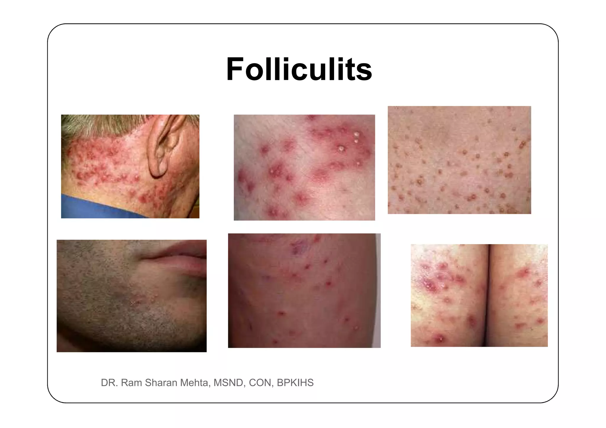 1.1.1. bacterial infection of skin [compatibility mode] | PDF