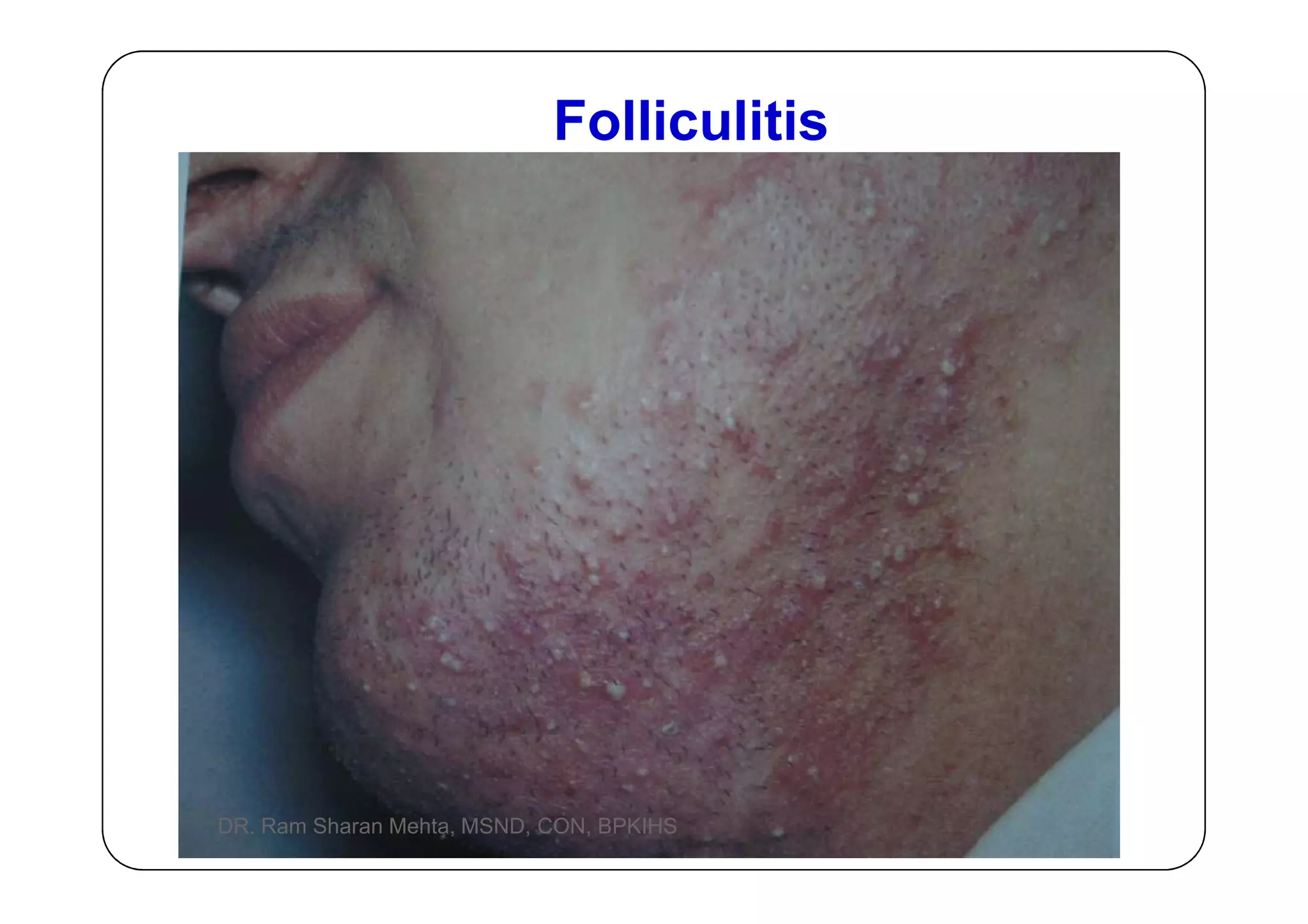 1.1.1. bacterial infection of skin [compatibility mode] | PDF