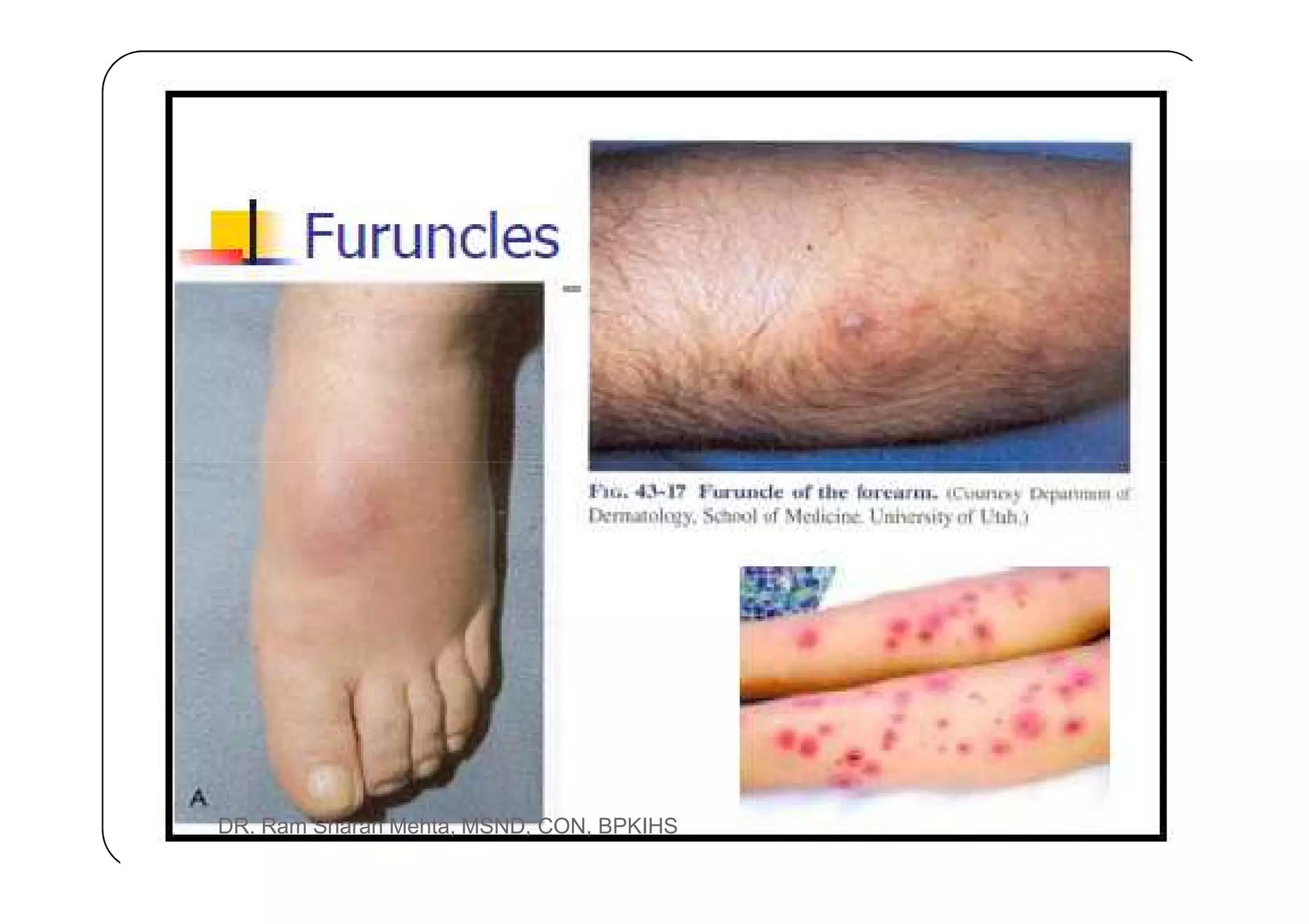 1.1.1. bacterial infection of skin [compatibility mode] | PDF