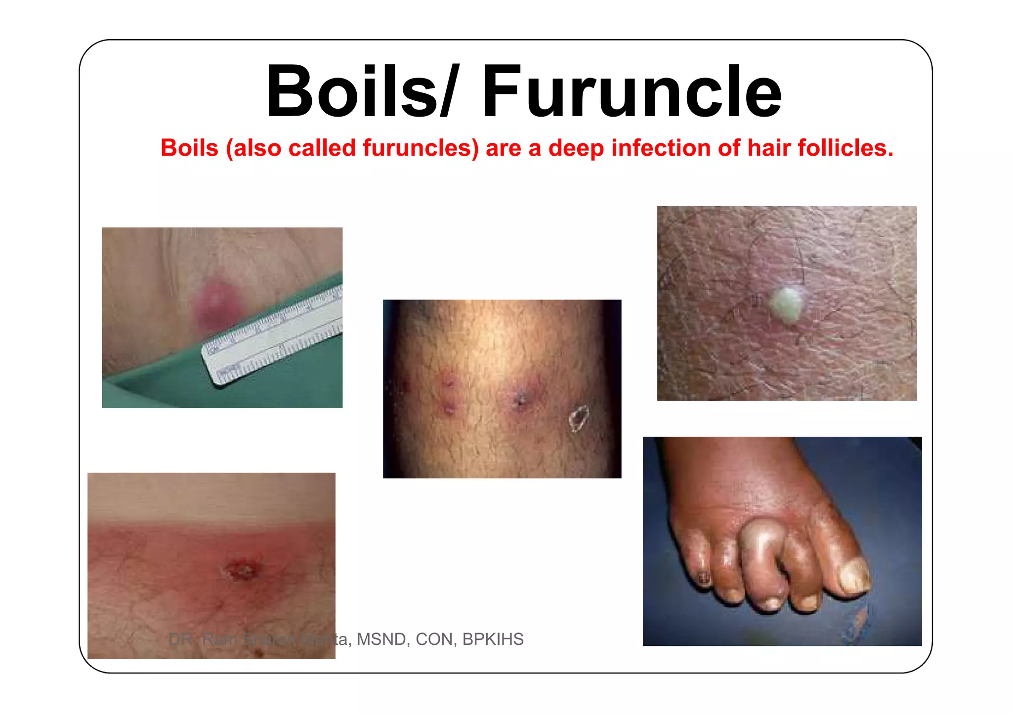 1.1.1. bacterial infection of skin [compatibility mode] | PDF