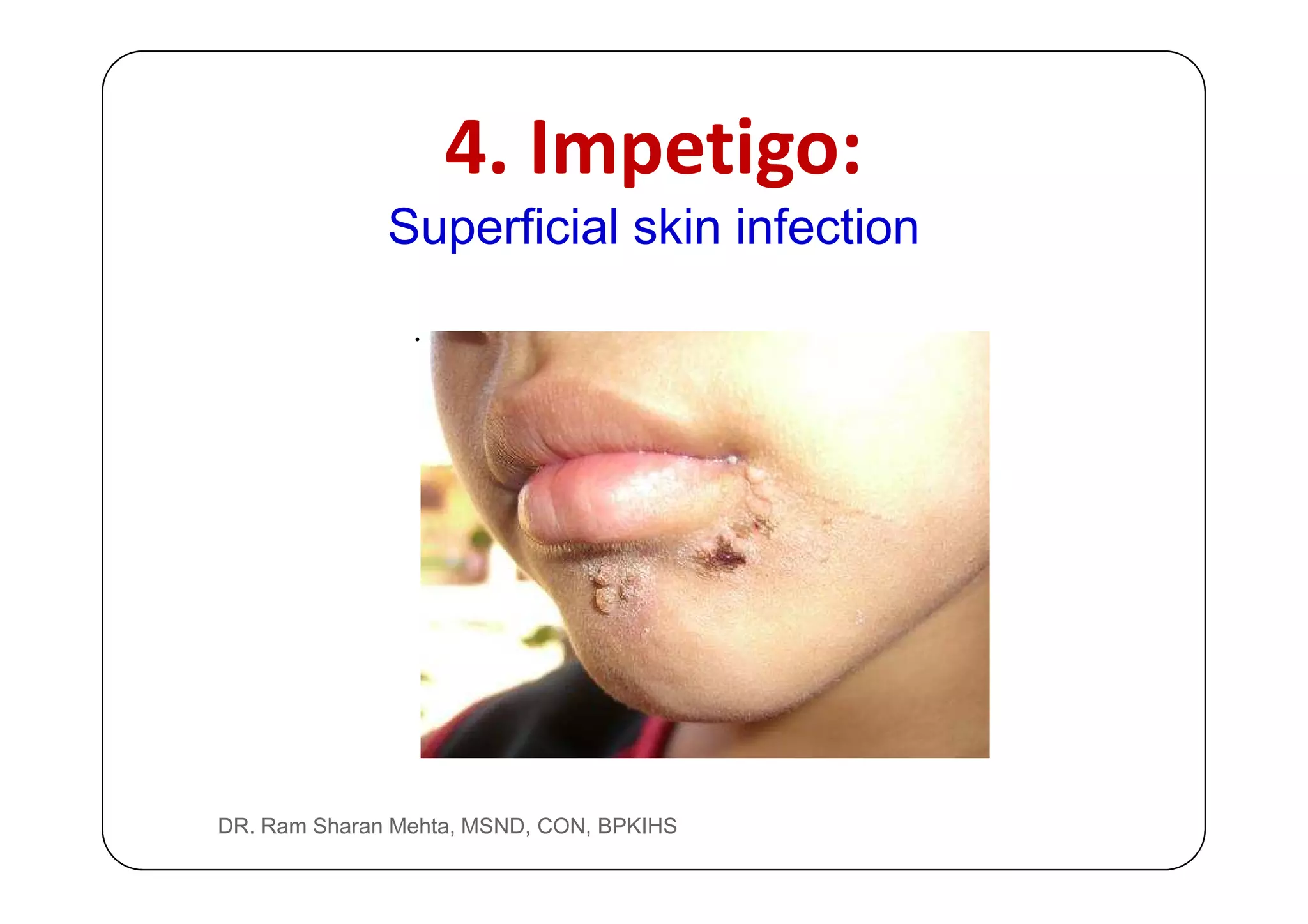1.1.1. bacterial infection of skin [compatibility mode] | PDF