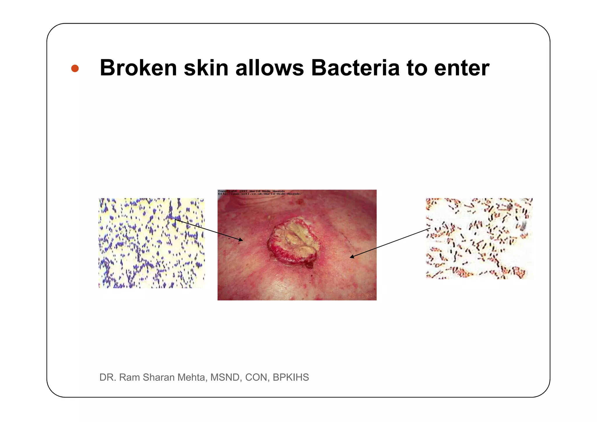 1.1.1. bacterial infection of skin [compatibility mode] | PDF | Skin ...