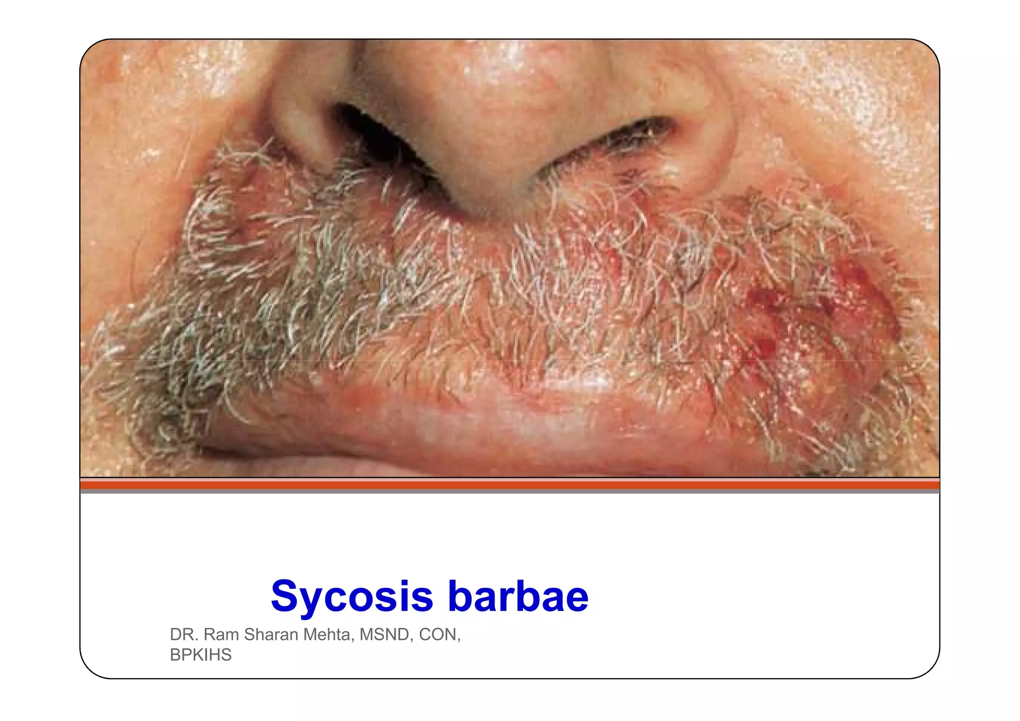 1.1.1. bacterial infection of skin [compatibility mode] | PDF