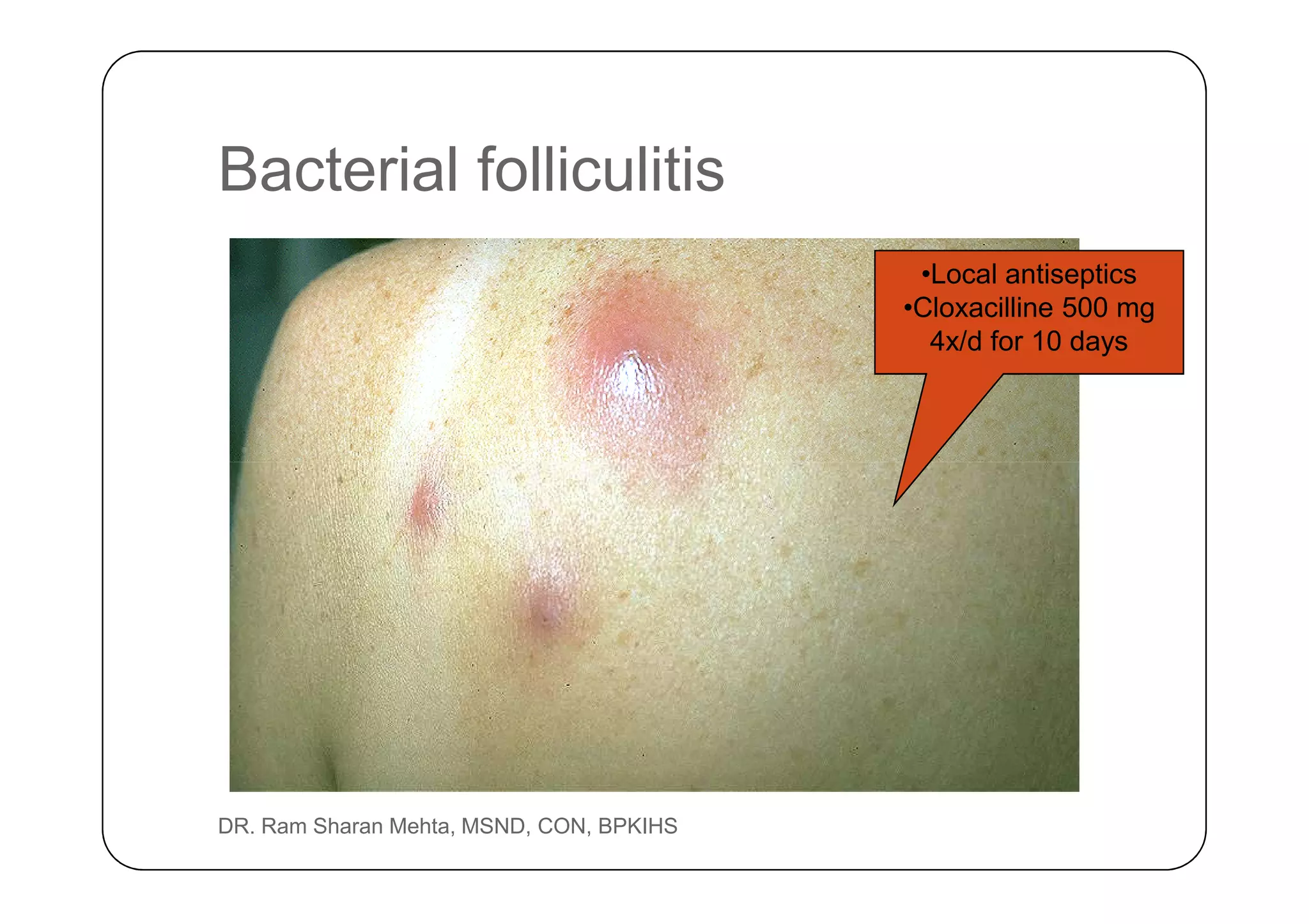 1.1.1. bacterial infection of skin [compatibility mode] | PDF