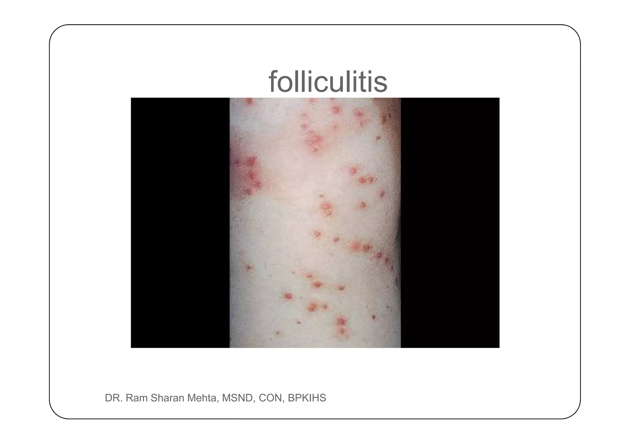 1.1.1. bacterial infection of skin [compatibility mode] | PDF