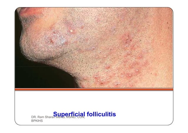 1.1.1. bacterial infection of skin [compatibility mode] | PDF | Skin ...