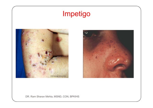 1.1.1. bacterial infection of skin [compatibility mode] | PDF | Skin ...