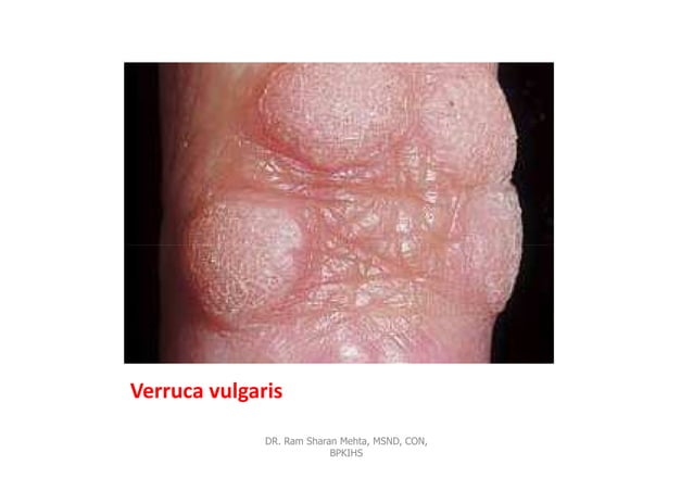 1.1.2. viral infections of skin [compatibility mode] | PDF