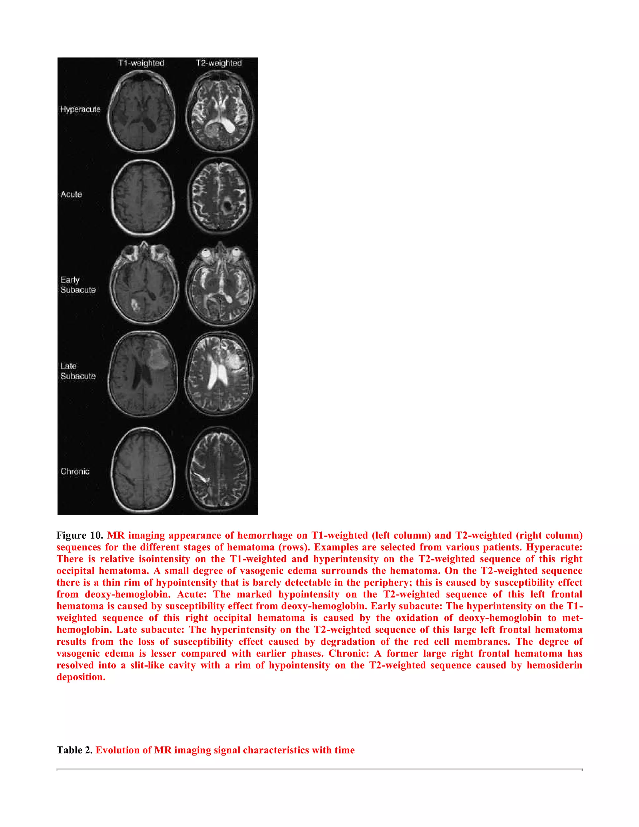Case record...Cerebral amyloid angiopathy (CAA), | PDF