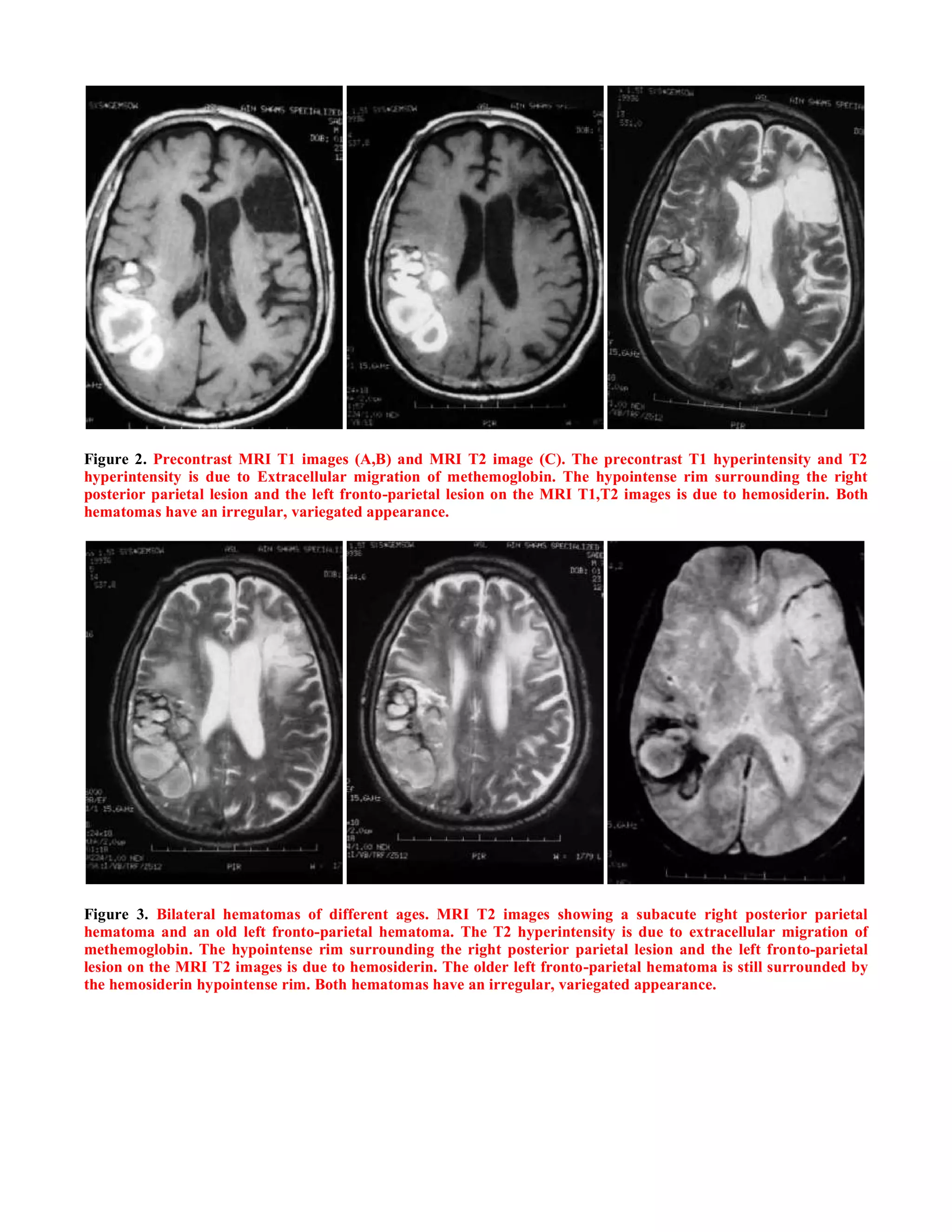 Case record...Cerebral amyloid angiopathy (CAA), | PDF