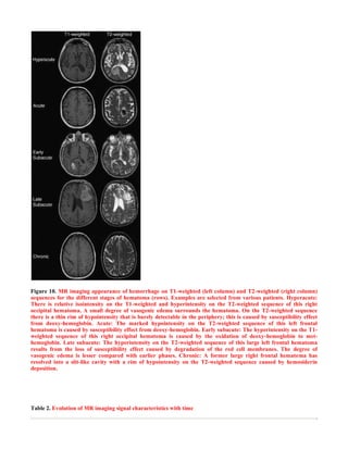 Case record...Cerebral amyloid angiopathy (CAA), | PDF