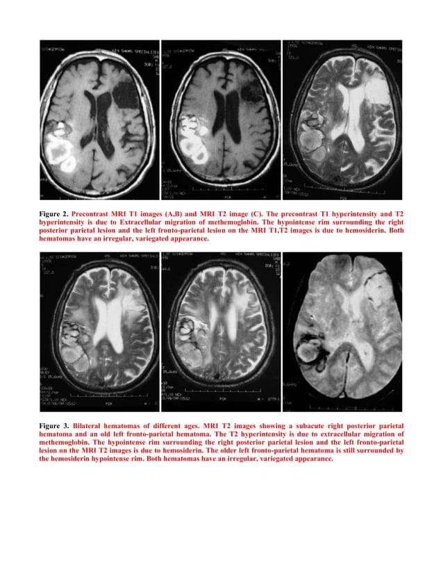 Case record...Cerebral amyloid angiopathy (CAA), | PDF | Brain and ...