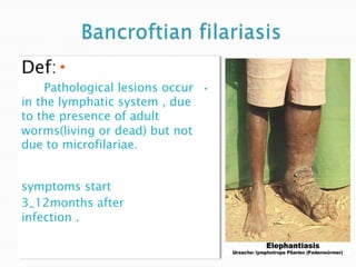 filariasis | PPTX