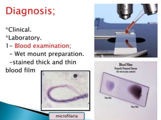 filariasis | PPT