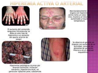 hiperemia | PPTX