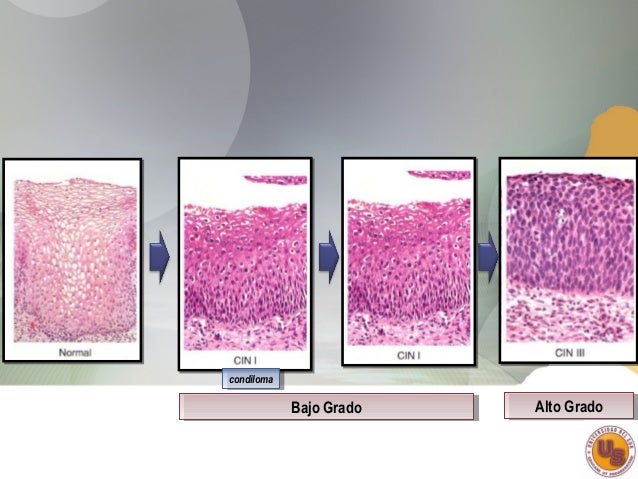Neoplasia Intraepitelial Cervical NIC