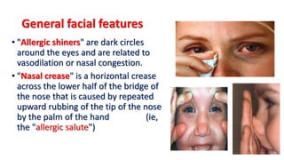 1. allergic rhinitis | PPT