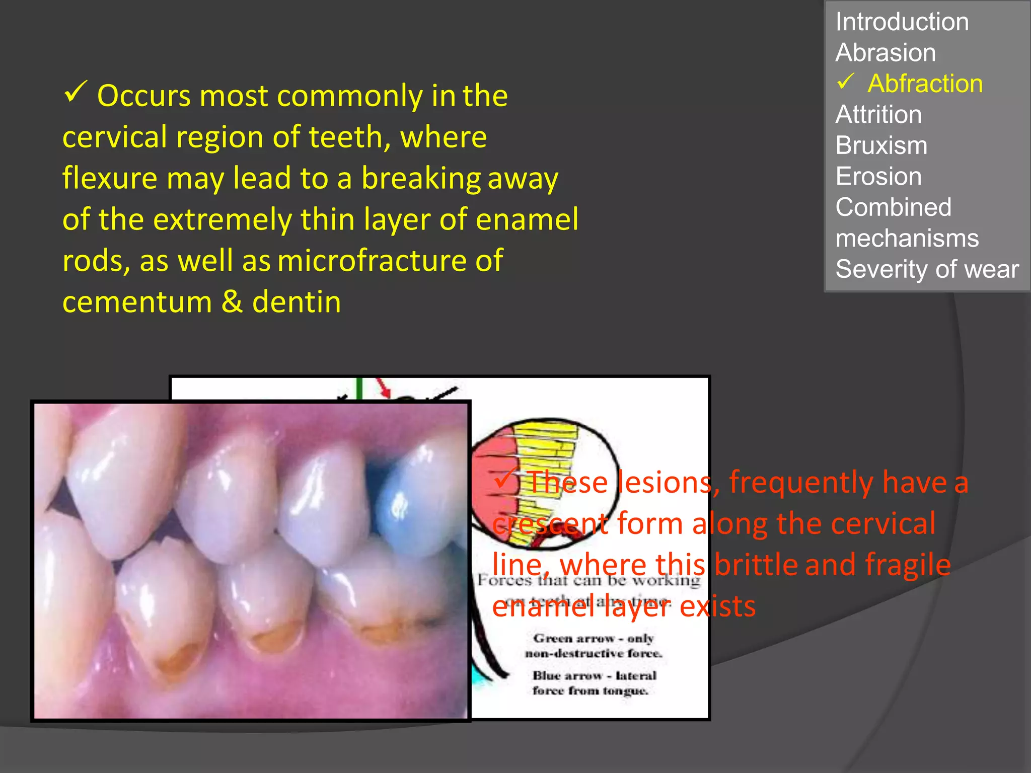 Restorative management of worn dentition (PART 1)- AETIOLOGY | PPTX