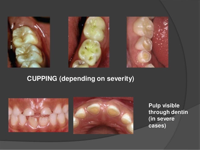 Restorative management of worn dentition (PART 1)- AETIOLOGY