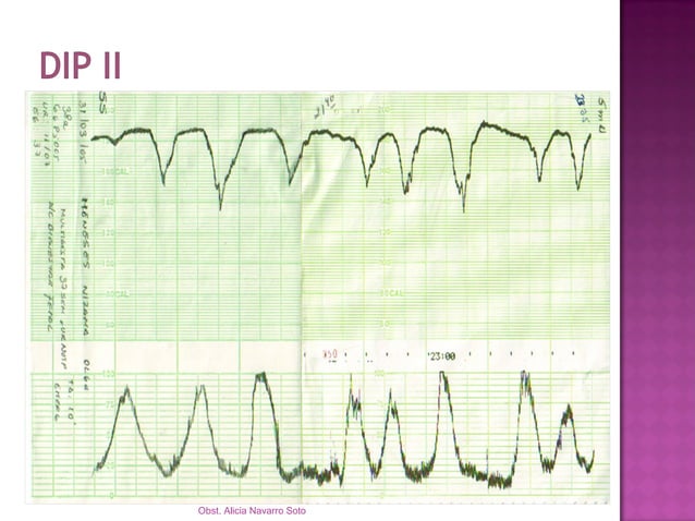 1. fisiopatologia del dip[1] | PPT