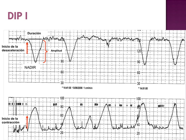 1. fisiopatologia del dip[1] | PPT