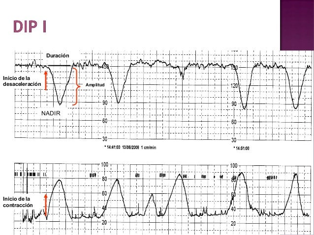 1. fisiopatologia del dip[1]