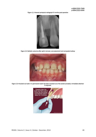 Replantation of Avulsed Permanent Anterior Teeth: A Case Report. | PDF