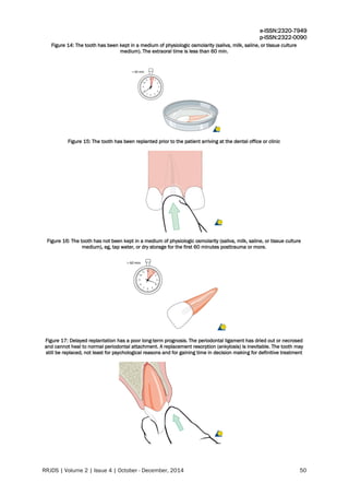 Replantation of Avulsed Permanent Anterior Teeth: A Case Report. | PDF