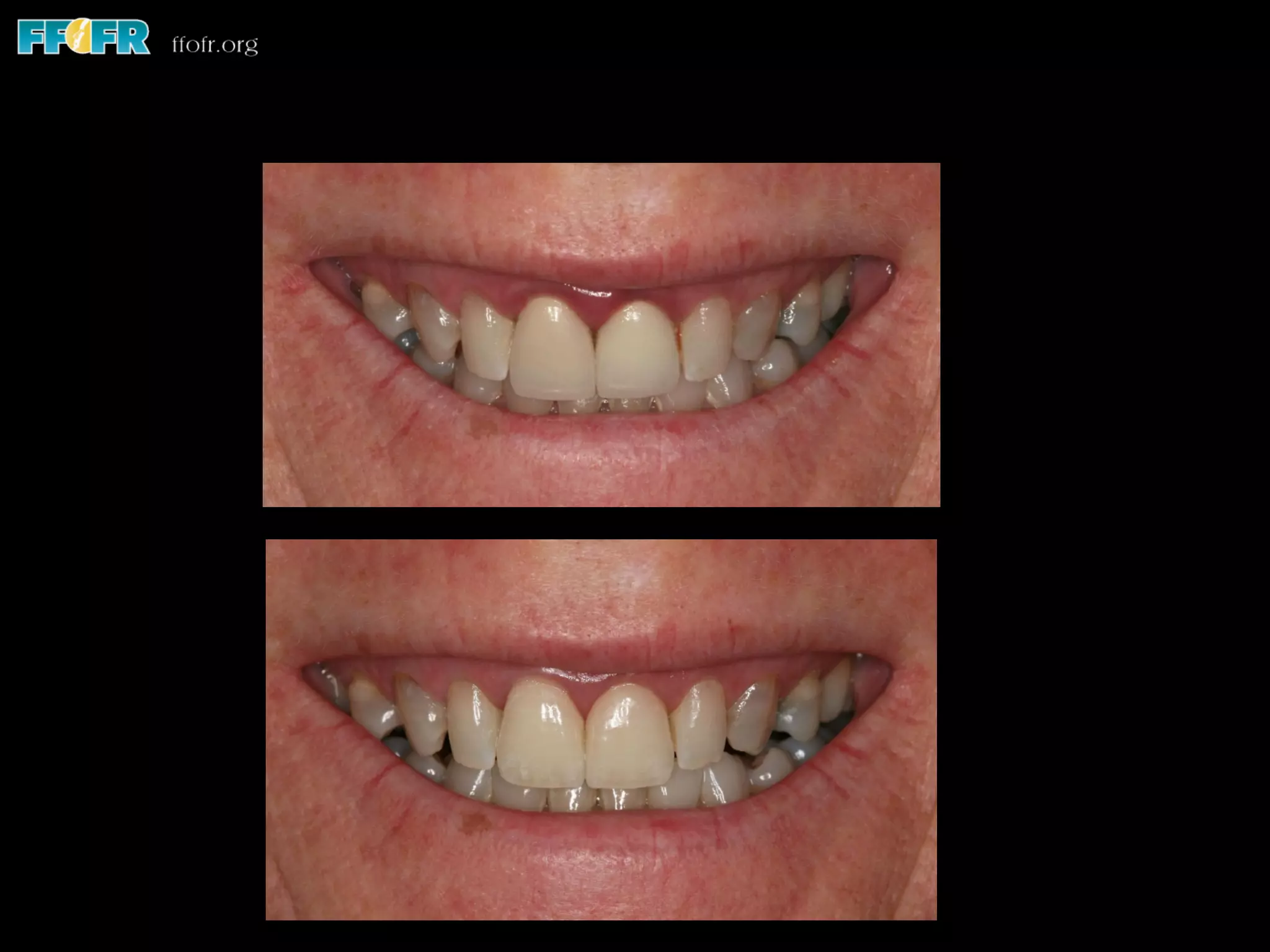 1.anterior mcc prep | PDF