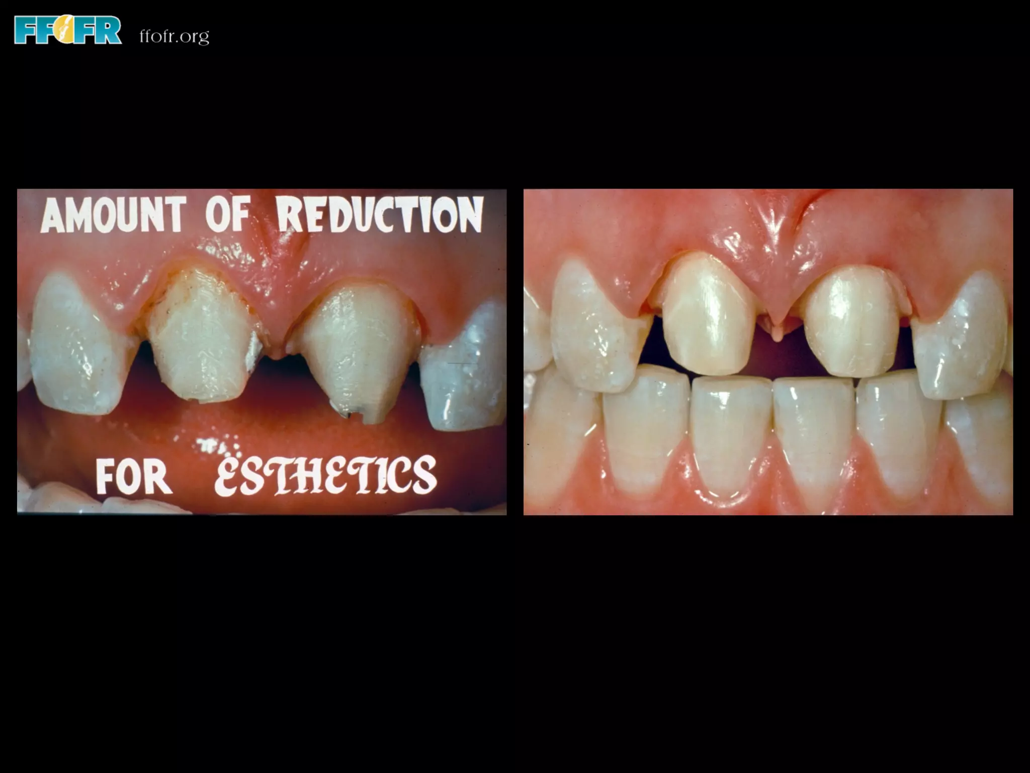1.anterior mcc prep | PDF
