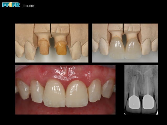 1.anterior mcc prep | PDF | Dental Health | Diseases and Conditions