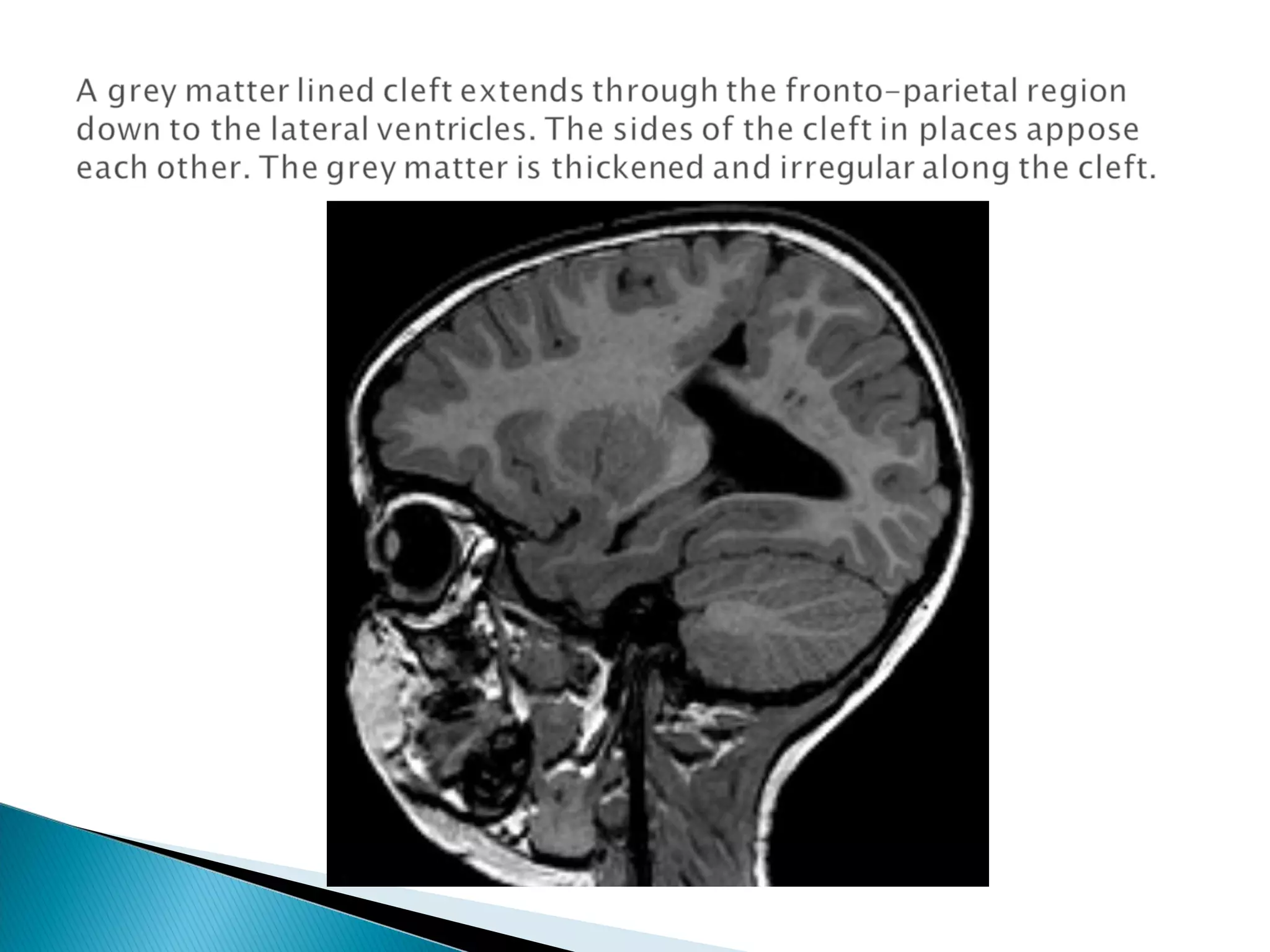1.schizencephaly 2.holoprosencephaly 3.porencephaly | PPT