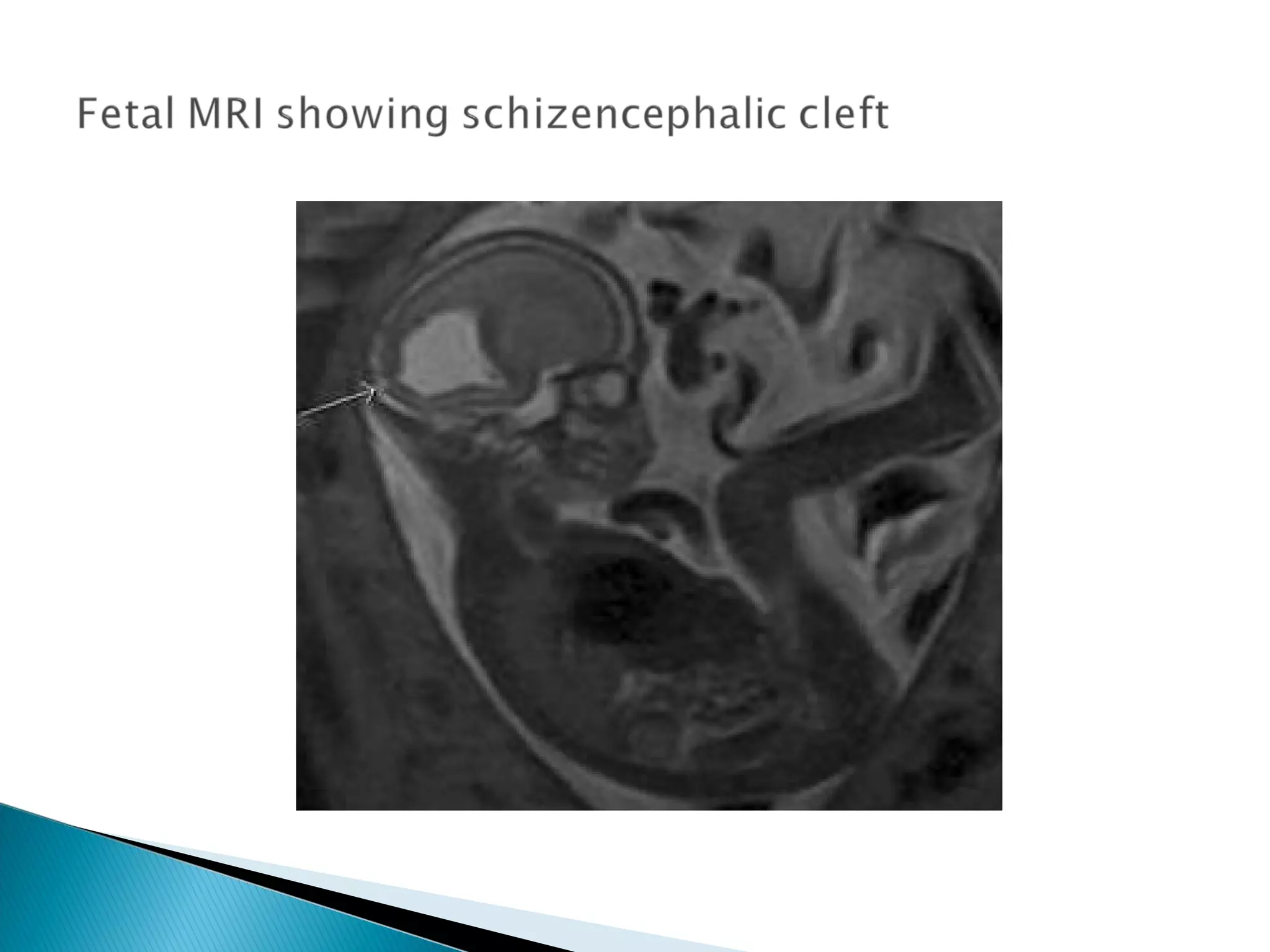 1.schizencephaly 2.holoprosencephaly 3.porencephaly | PPT