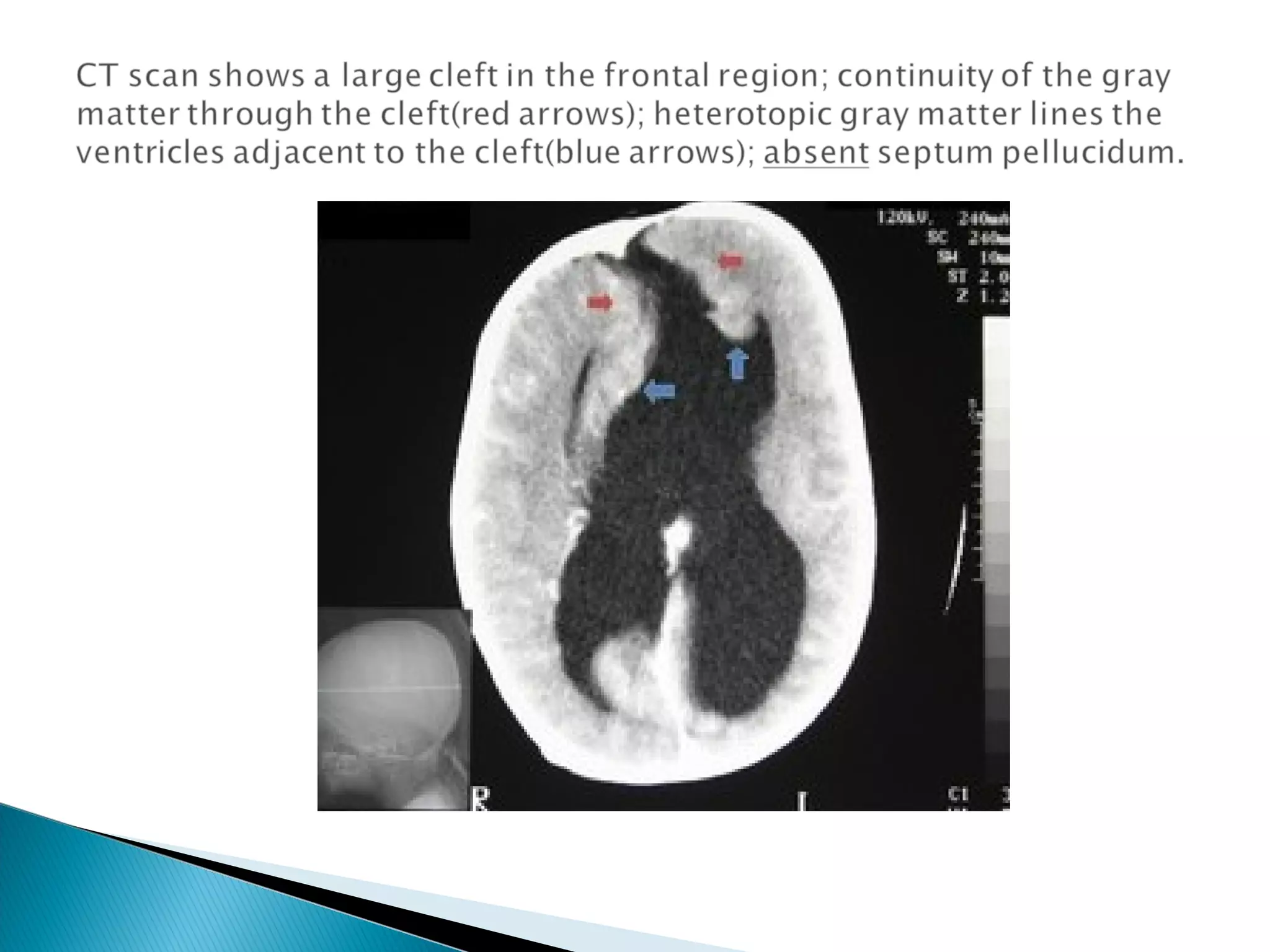 1.schizencephaly 2.holoprosencephaly 3.porencephaly | PPT