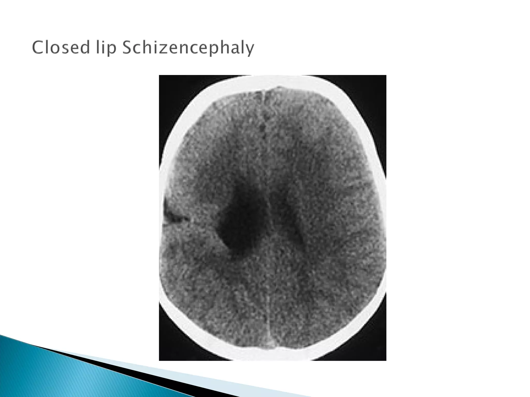 1.schizencephaly 2.holoprosencephaly 3.porencephaly | PPT