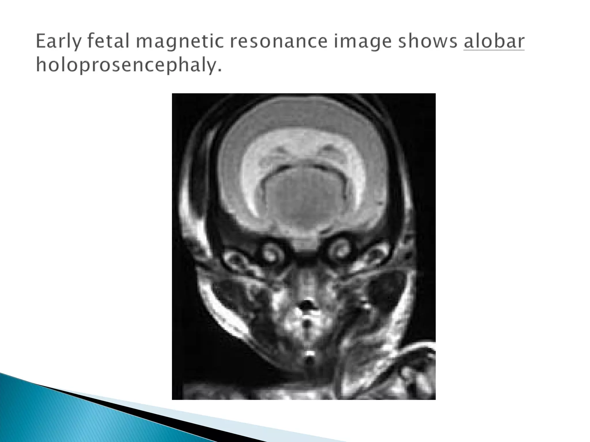 1.schizencephaly 2.holoprosencephaly 3.porencephaly | PPT