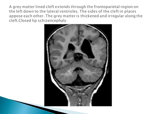 1.schizencephaly 2.holoprosencephaly 3.porencephaly | PPT | Pregnancy ...