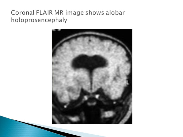 1.schizencephaly 2.holoprosencephaly 3.porencephaly | PPT | Pregnancy ...
