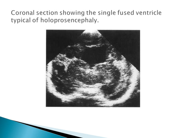1.schizencephaly 2.holoprosencephaly 3.porencephaly | PPT | Pregnancy ...