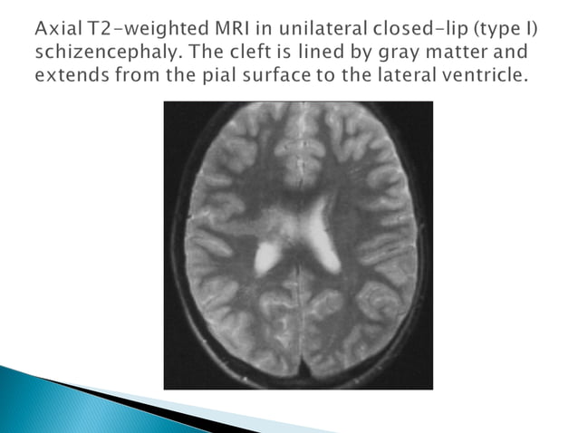 1.schizencephaly 2.holoprosencephaly 3.porencephaly | PPT | Pregnancy ...