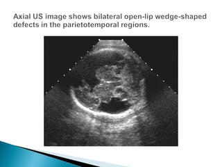 Fetal Porencephaly