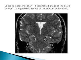 Holoprosencephaly Mri