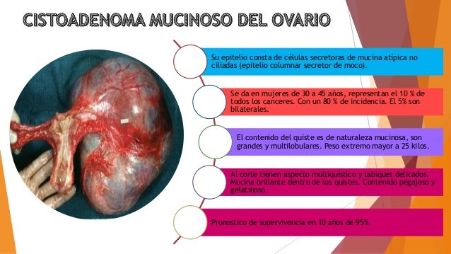 cistoadenoma y cistoadenocarcinoma mucinosos del ovario