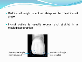 Permanent Maxillary Central Incisor | PPTX