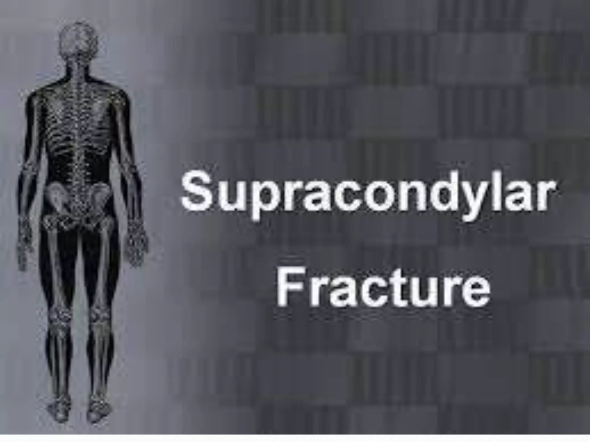 supracondylar fracture | PPT