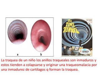 1. aparato respiratorio del niño degraba | PPTX