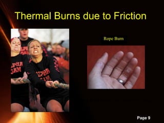 1.3.3 burns | PPT