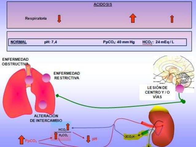 ácidosis y alcalosis basica, sencilla. | PPTX | Lung and Respiratory ...